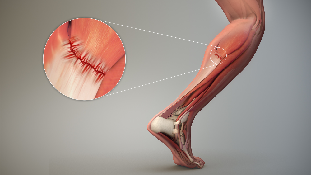 Muscle Strain And Tear ATP Physio Clinic Muscle Strain And Tear ATP Physio Clinic